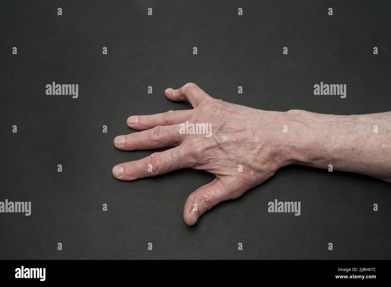 Dupuytren's Contracture, Right Hand, Palm Down, On Gray Background ...