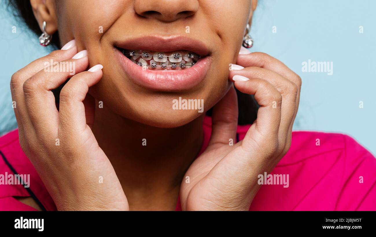 Closeup Shy unrecognizable african american woman demonstrates braces ...