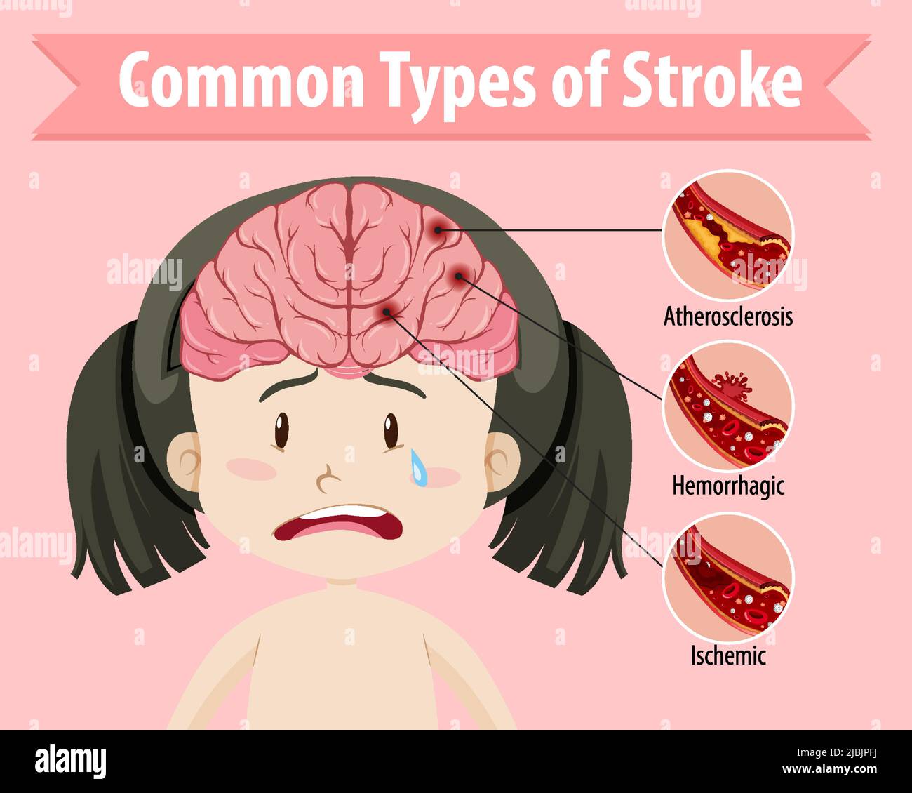 Human With Common Types Of Stroke Illustration Stock Vector Image And Art