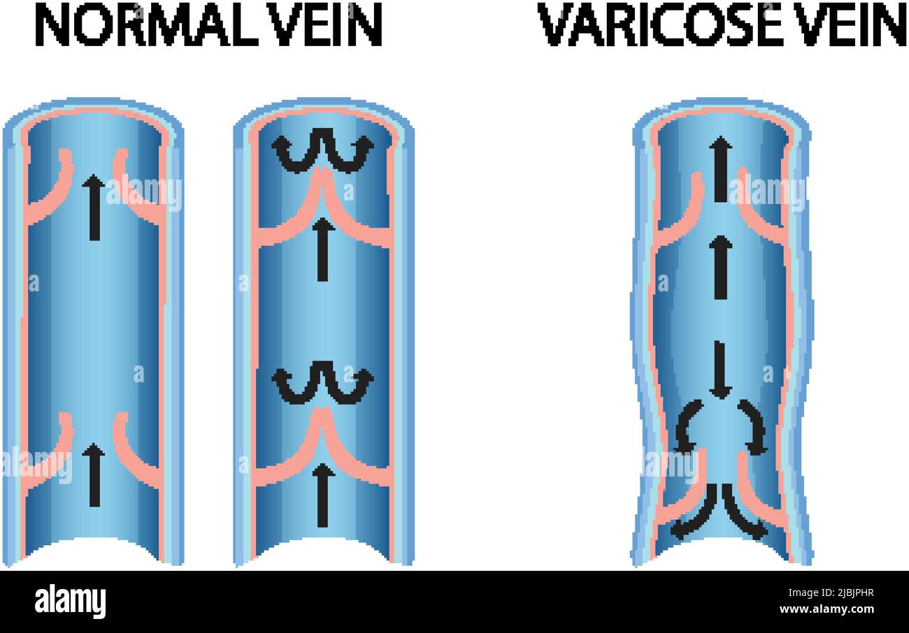 A comparison of normal vein with varicose vein illustration Stock ...
