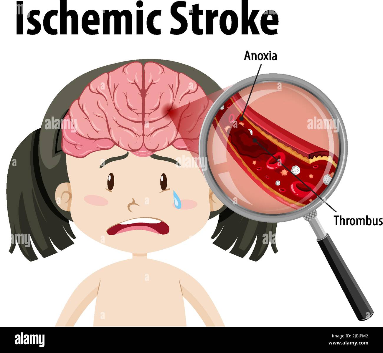 Human with Ischemic stroke illustration Stock Vector Image & Art - Alamy
