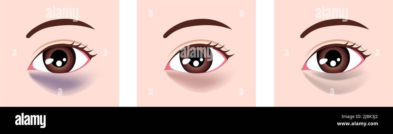 Color types of dark circles under eyes. Vector illustration Stock ...