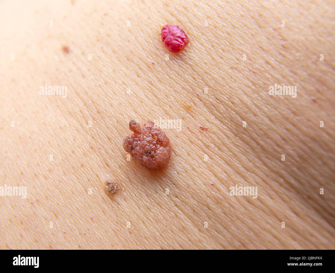 Closeup photo of skin tag or skin mole on a human body. Cherry Angioma ...