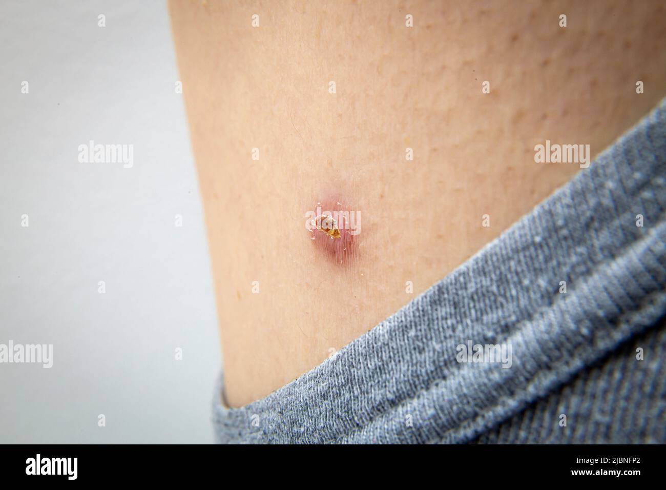 Little scar on the skin on a human body after the medical dermatologist ...