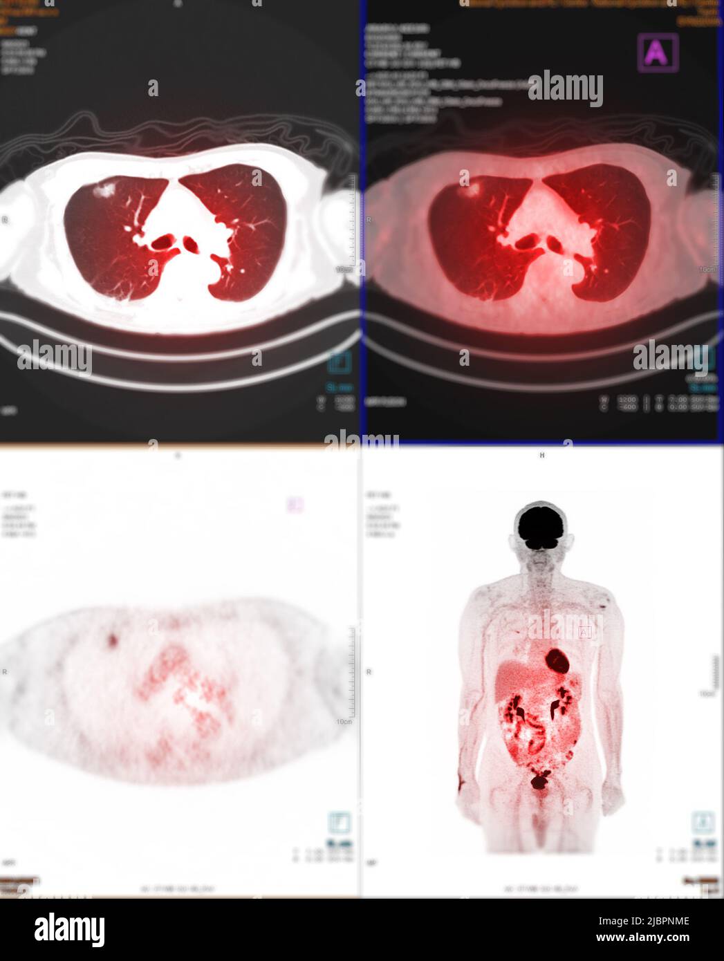PET Scan image of thorax or chest Comparison Axial , Coronal for detect ...