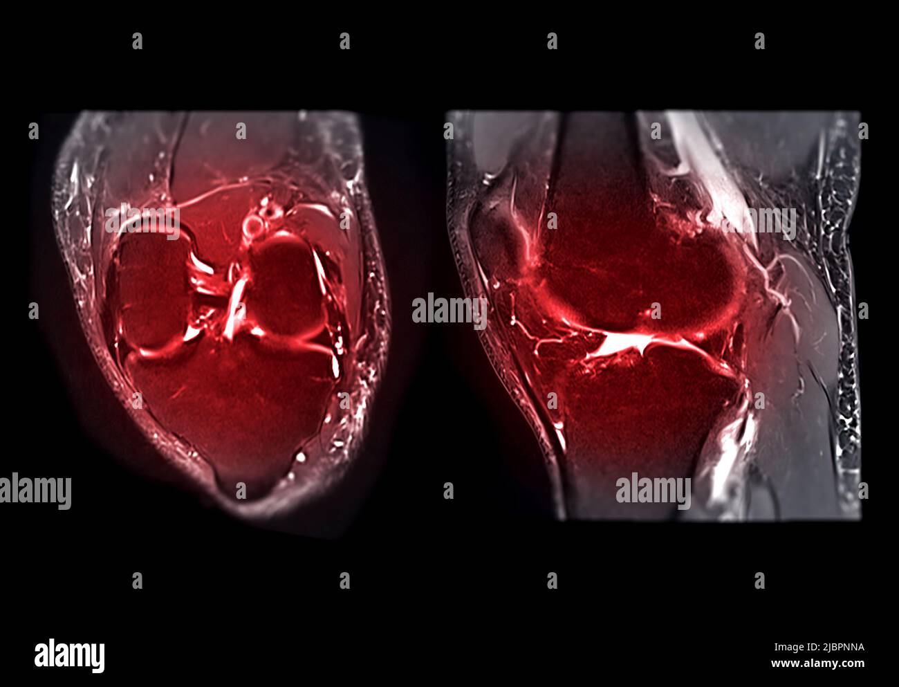 Magnetic resonance imaging of the knee or MRI knee T2W fat suppreesion ...