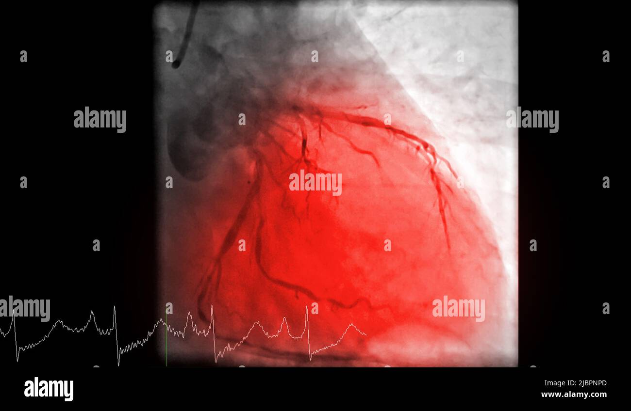 Cardiac Catheterization