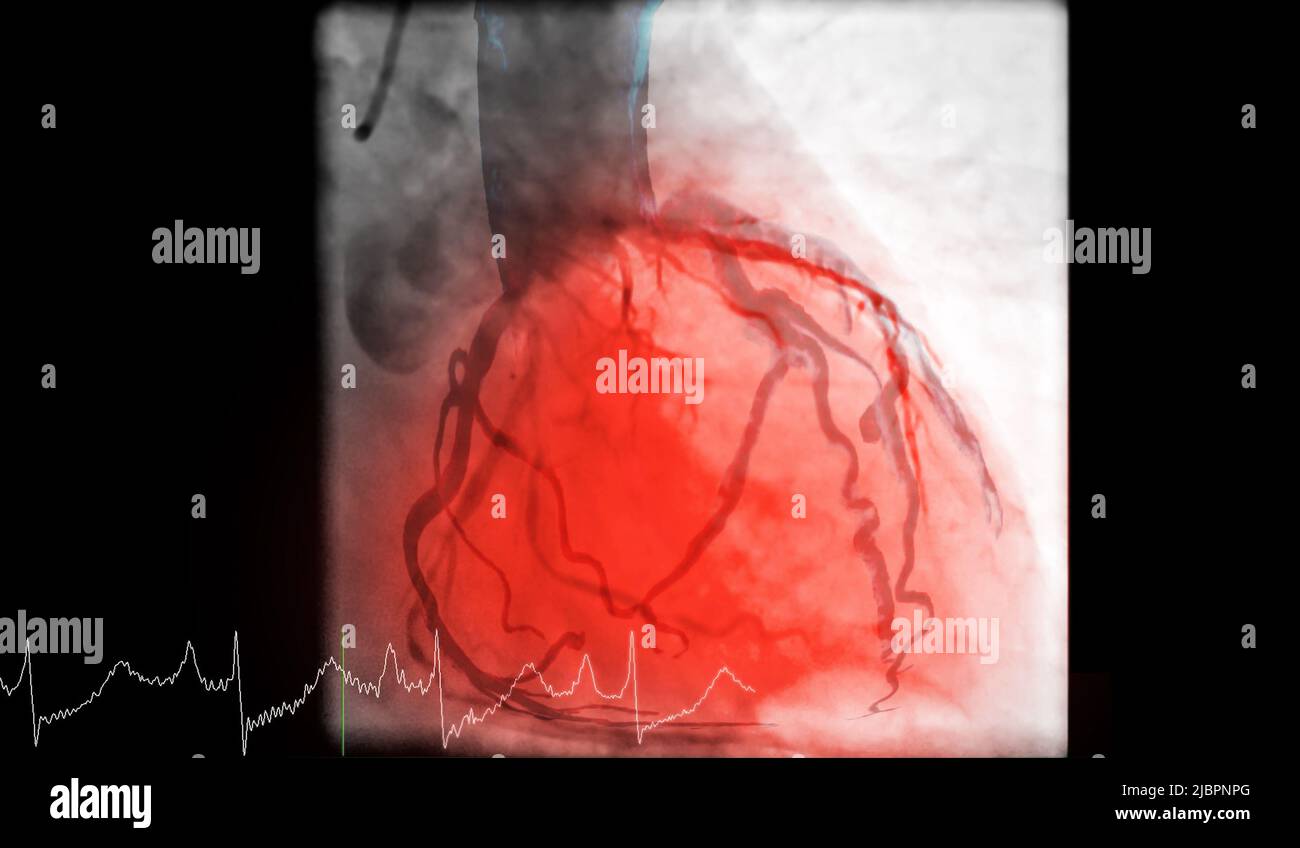 Cardiac catheterization is a test used to find out cardiac arrest Stock ...