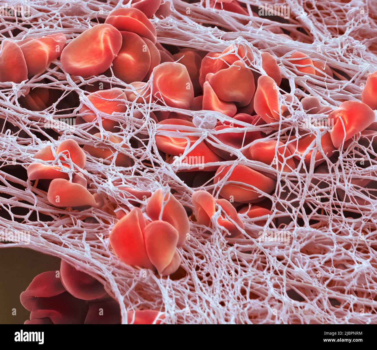 Blood clot. Coloured scanning electron micrograph (SEM) of red blood ...