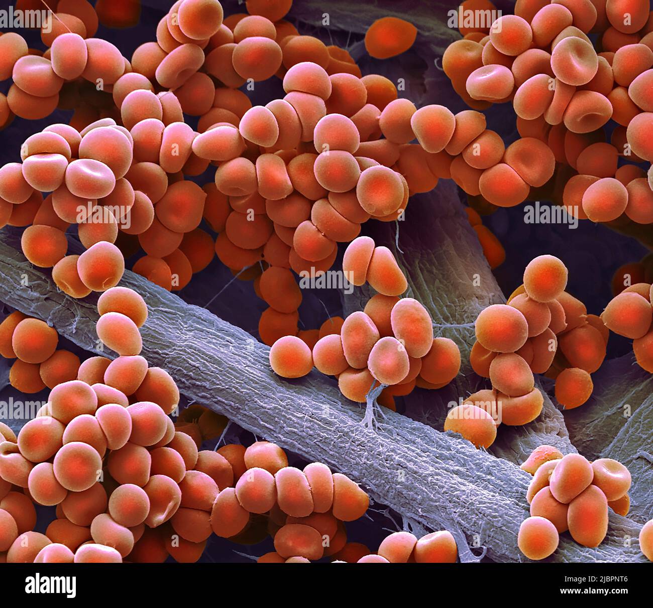 Enlarged red blood cells. Conceptual coloured scanning electron micrograph (SEM) of enlarged red ...