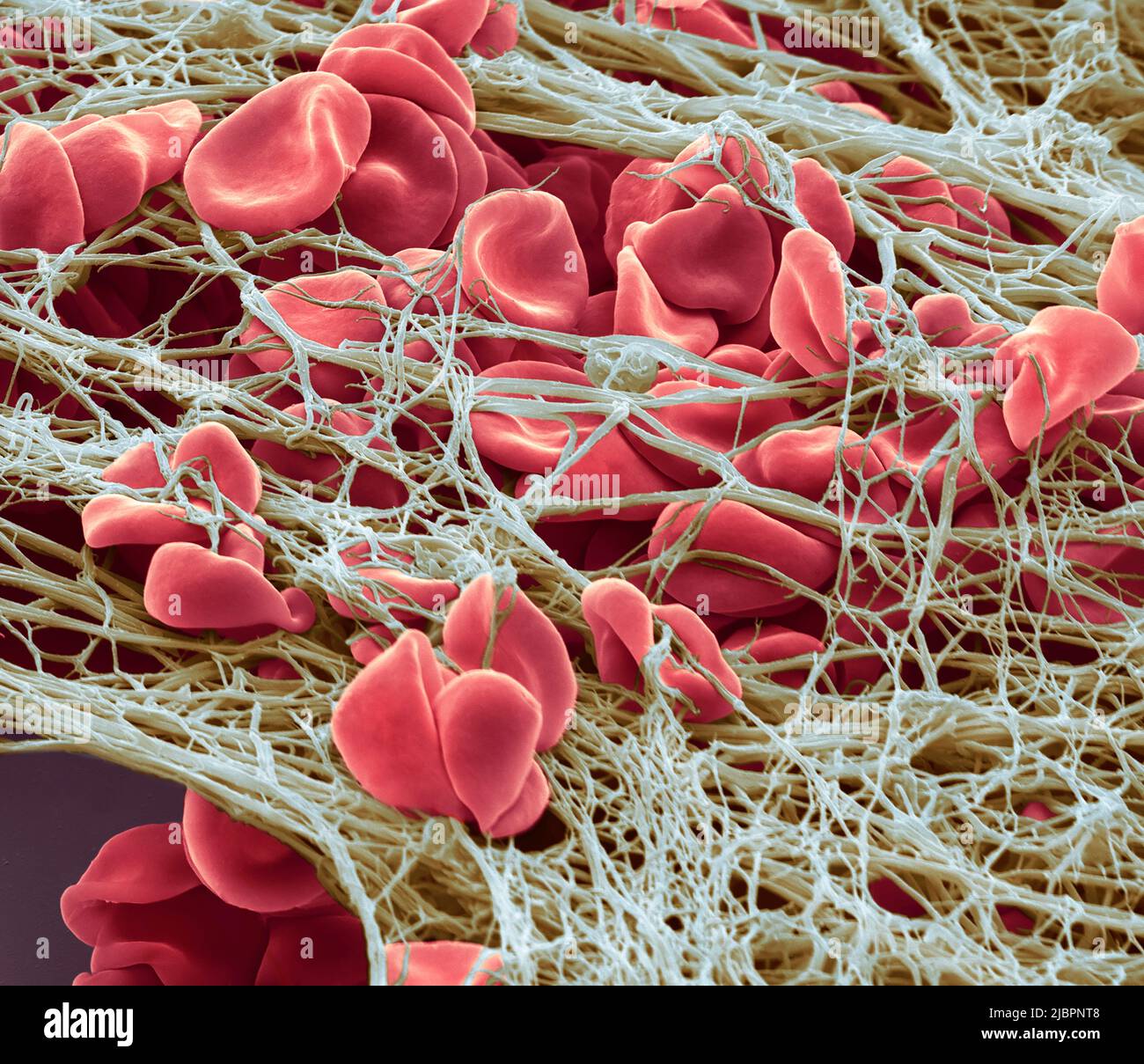 Blood clot. Coloured scanning electron micrograph (SEM) of red blood ...
