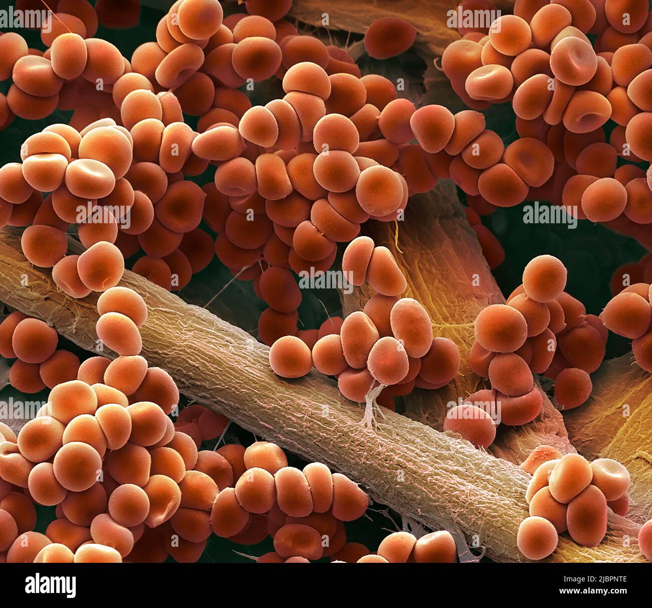 Enlarged red blood cells. Conceptual coloured scanning electron ...