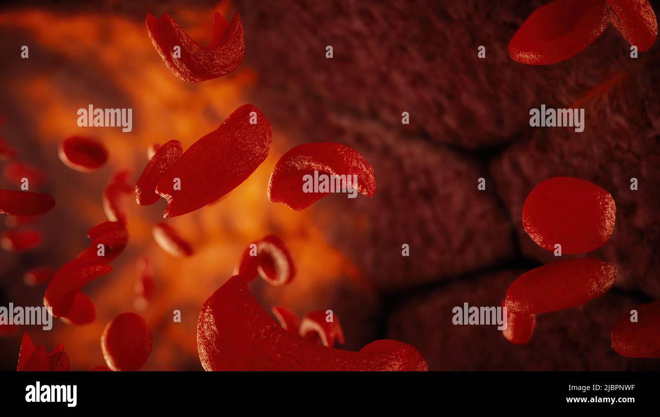 Sickle cell blood flow, illustration Stock Photo - Alamy