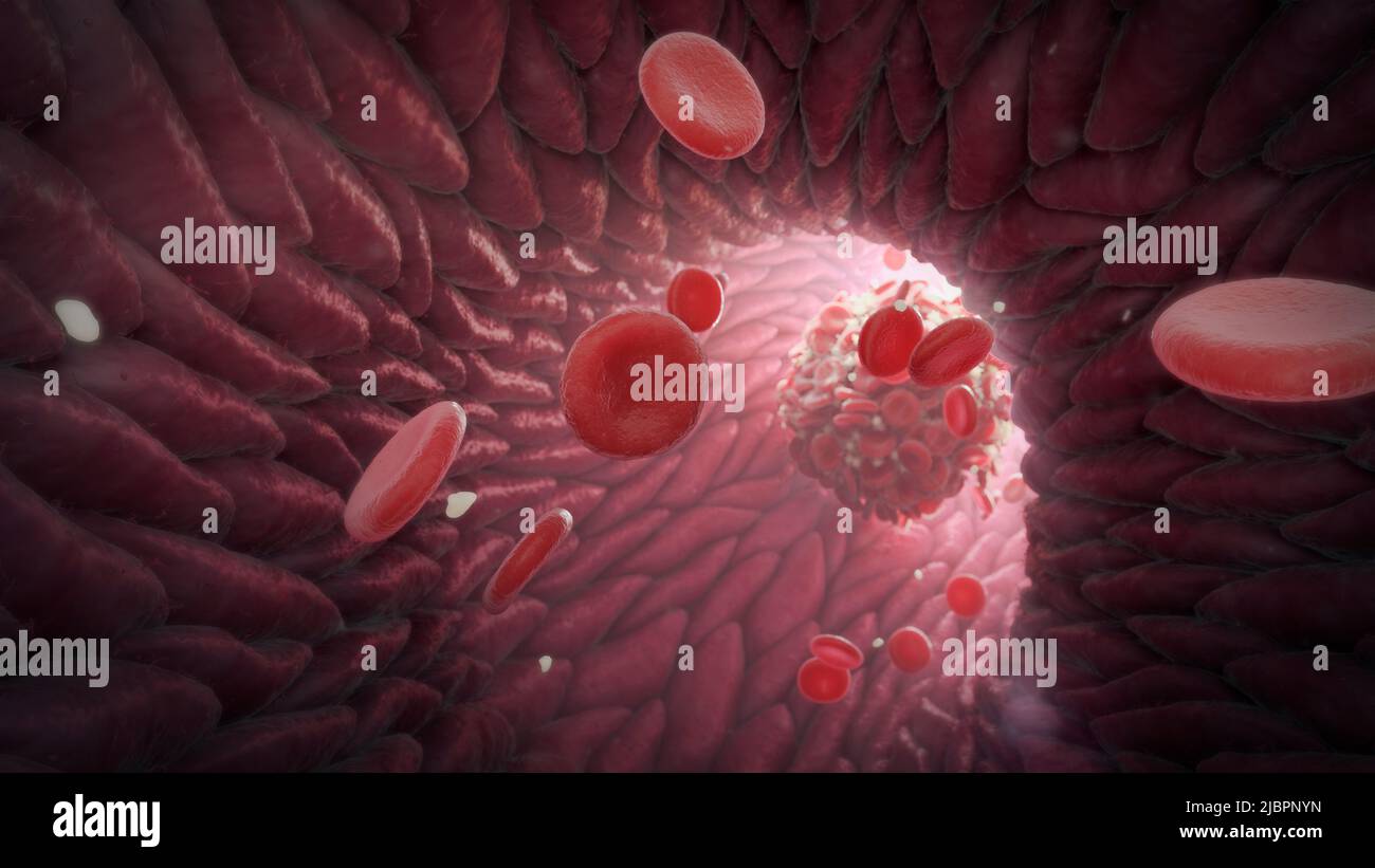 Illustration of a human blood vessel with a forming blood clot Stock ...