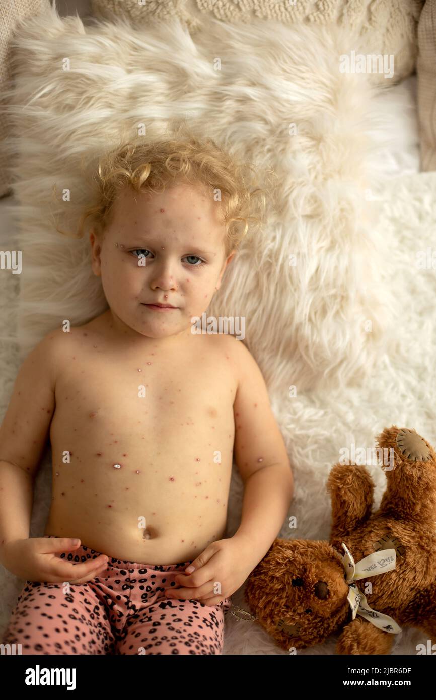 Little toddler girl with chickenpox in bed, playing at home, quarantine ...