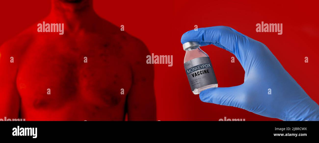 Doctor's hand holding monkeypox vaccine with male chest affected by ...