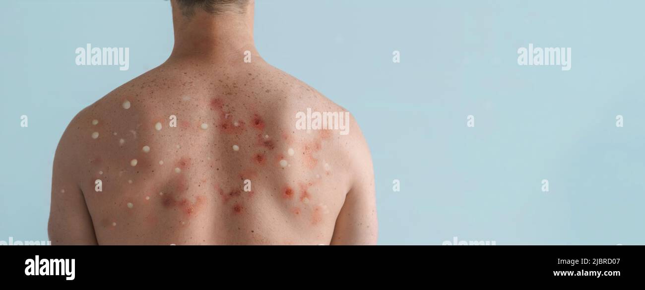 Viral skin disease hi-res stock photography and images - Alamy