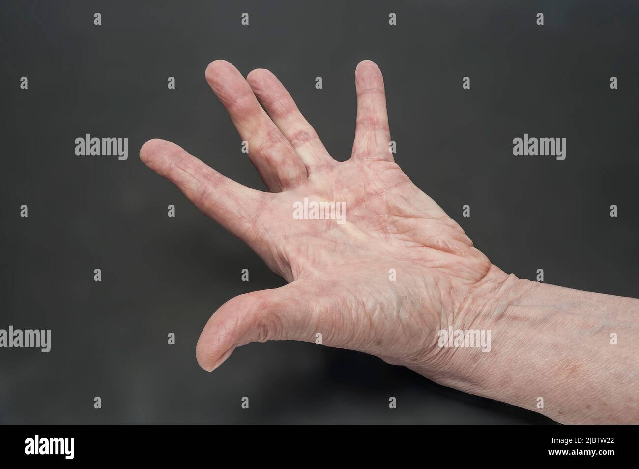 Dupuytrens syndrome hi-res stock photography and images - Alamy
