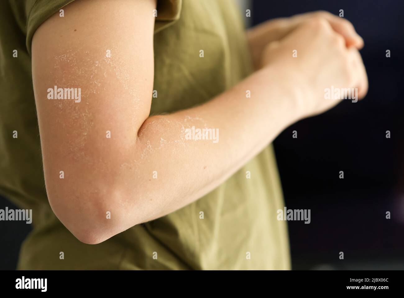 Peeling Skin At Shoulder From Sunburn Effect On Body Of Young Woman