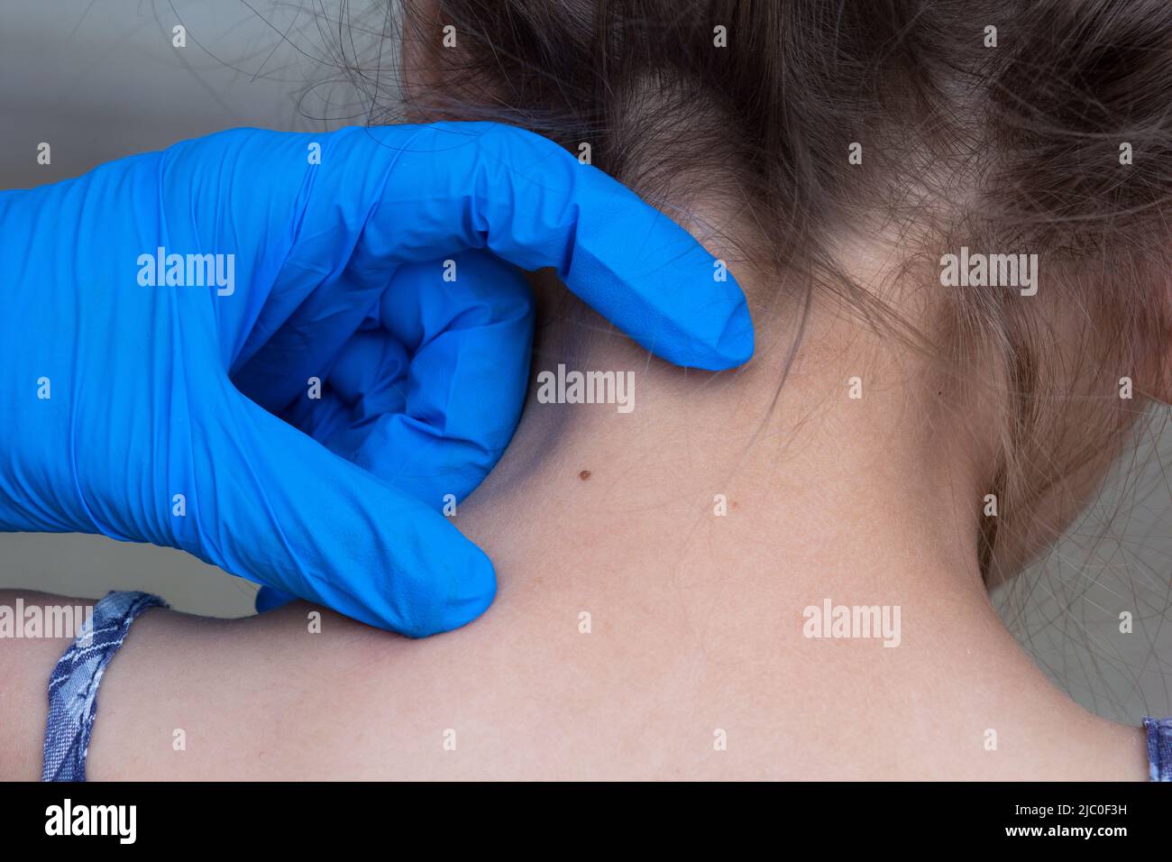 Cropped woman hands in medical gloves showing birthmark on child neck ...