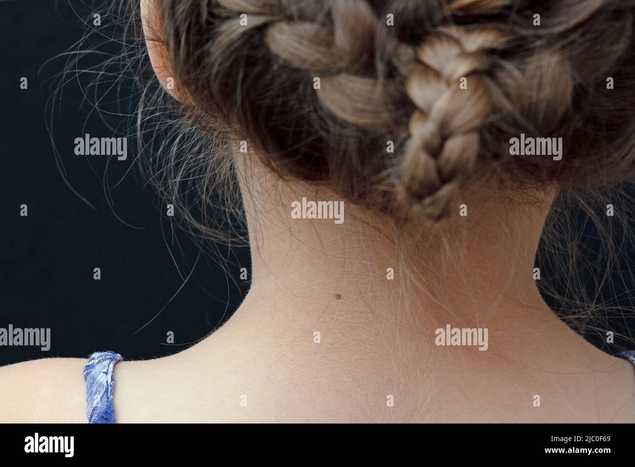 Birthmark on child neck behind over black backgound Stock Photo - Alamy