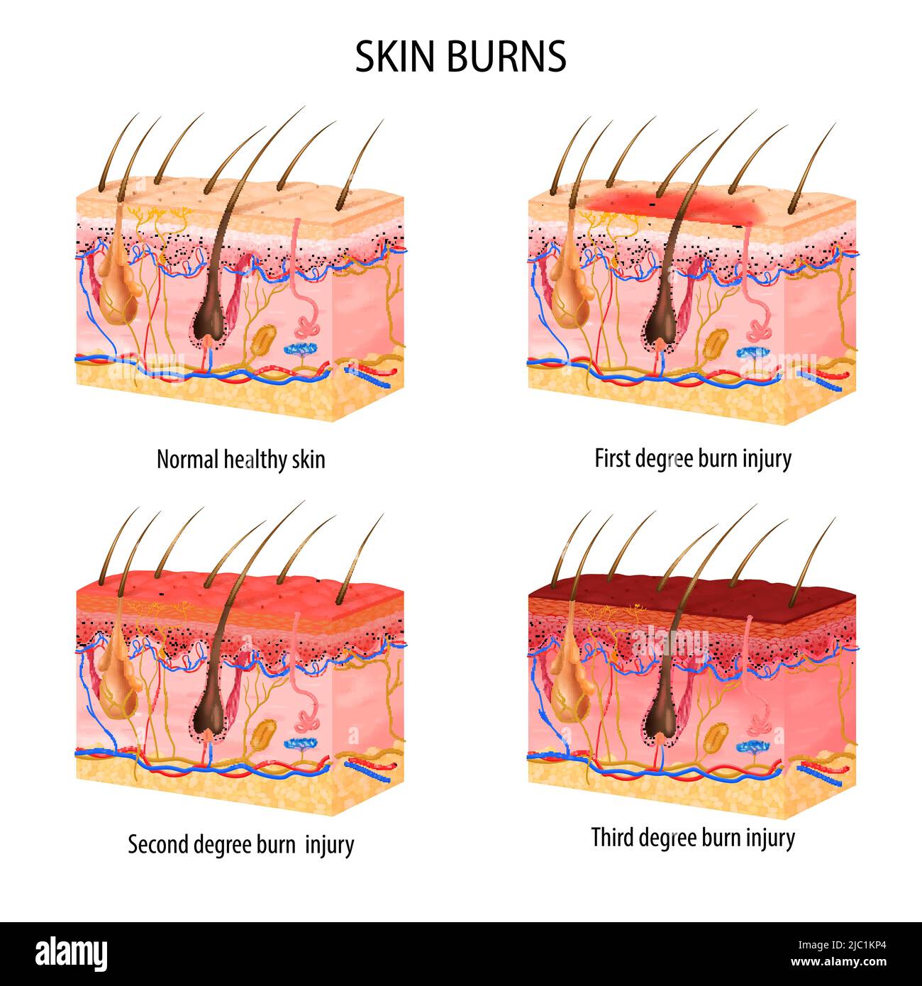 Realistic set of normal and three degree of burns skin structure isolated on white background ...