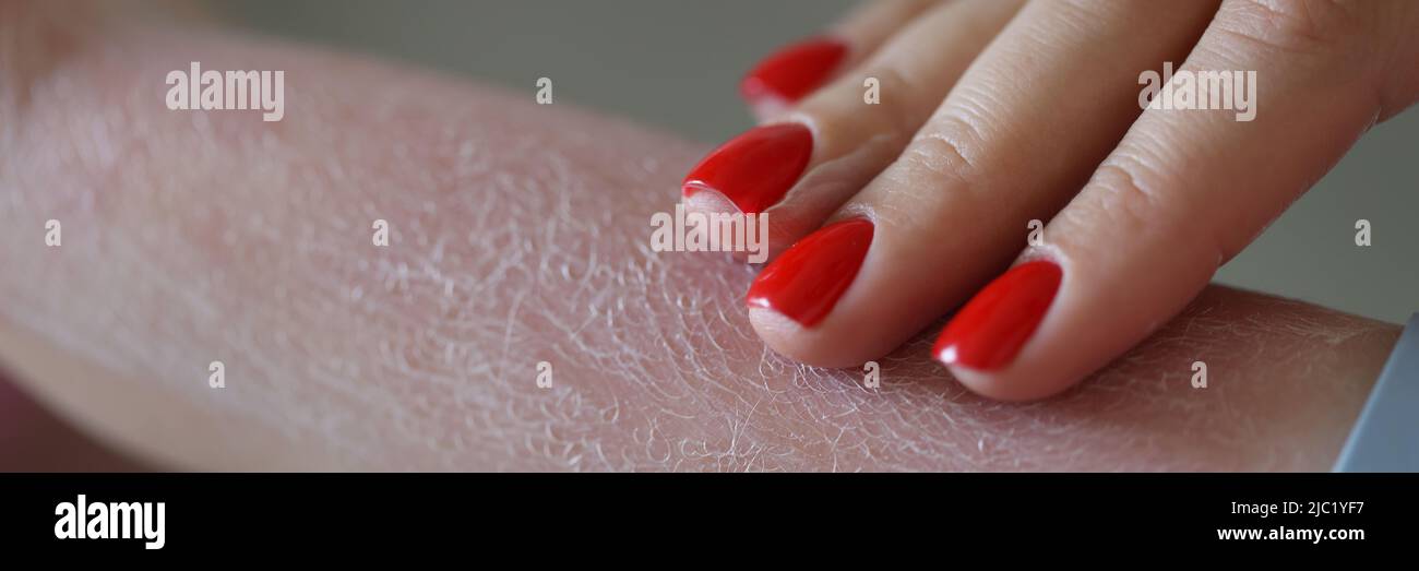 Female hand using burn cream after sunburn Stock Photo - Alamy