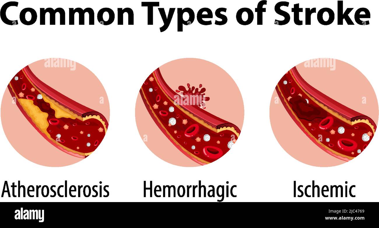Infographic of common types of stroke illustration Stock Vector Image ...
