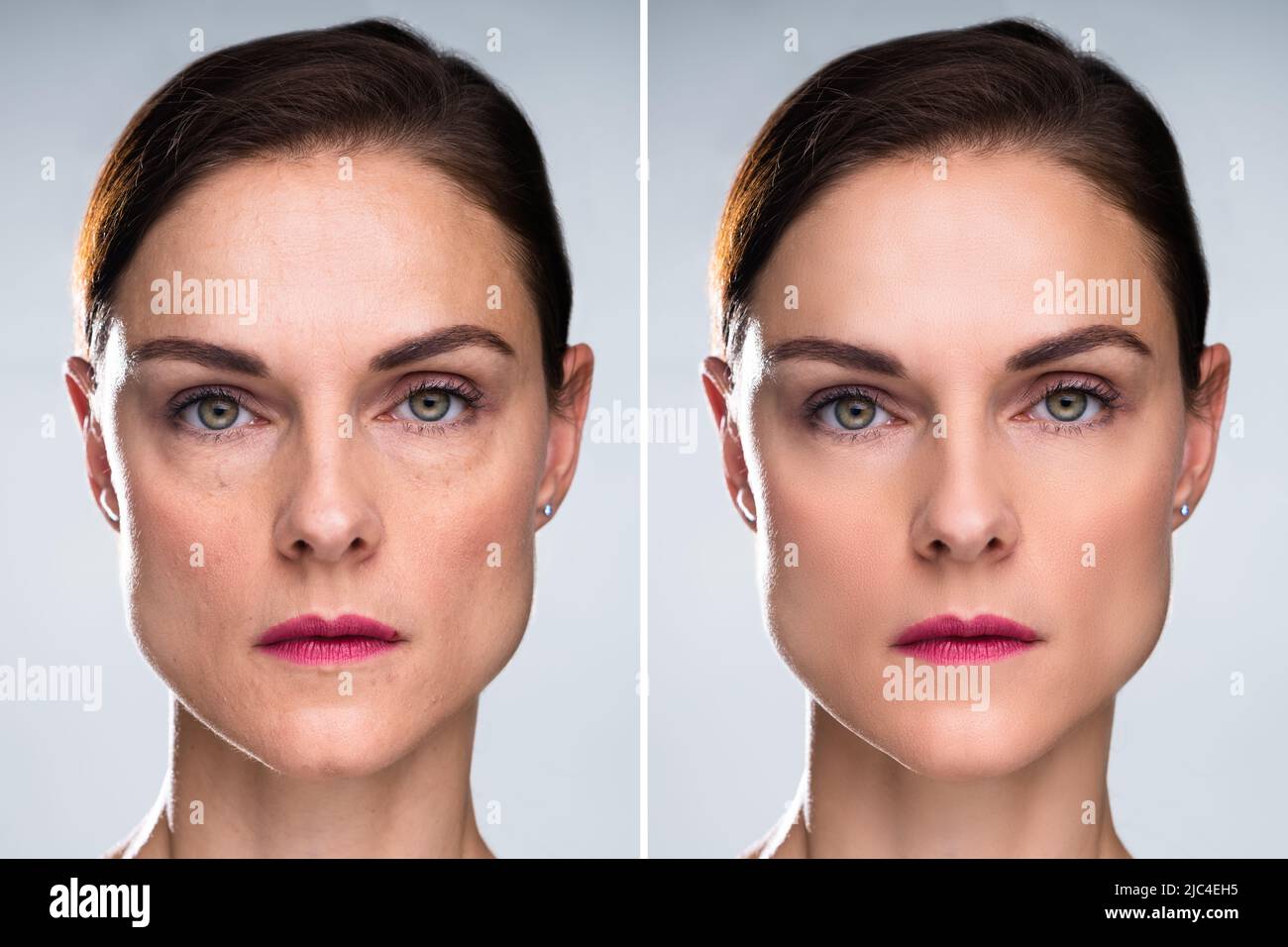 Photo Of Anti-aging Procedures On Caucasian Woman Face Stock Photo - Alamy