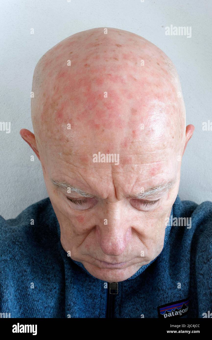Bald man head hi-res stock photography and images - Alamy
