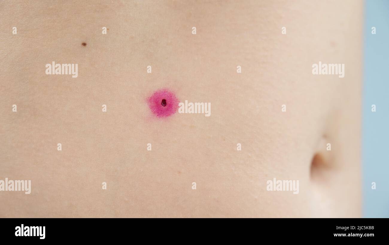 Close-up of a removed wart on a woman's abdomen. Human papillomavirus ...