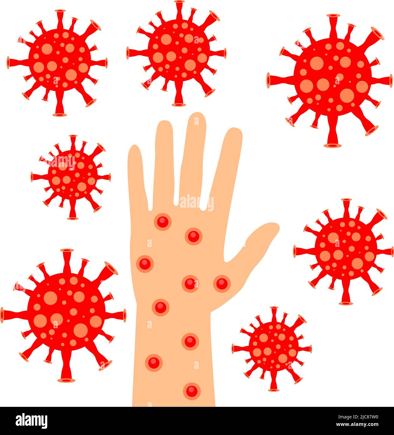 Monkeypox virus, hand in smallpox ulcers. Smallpox monkeys. Vector ...