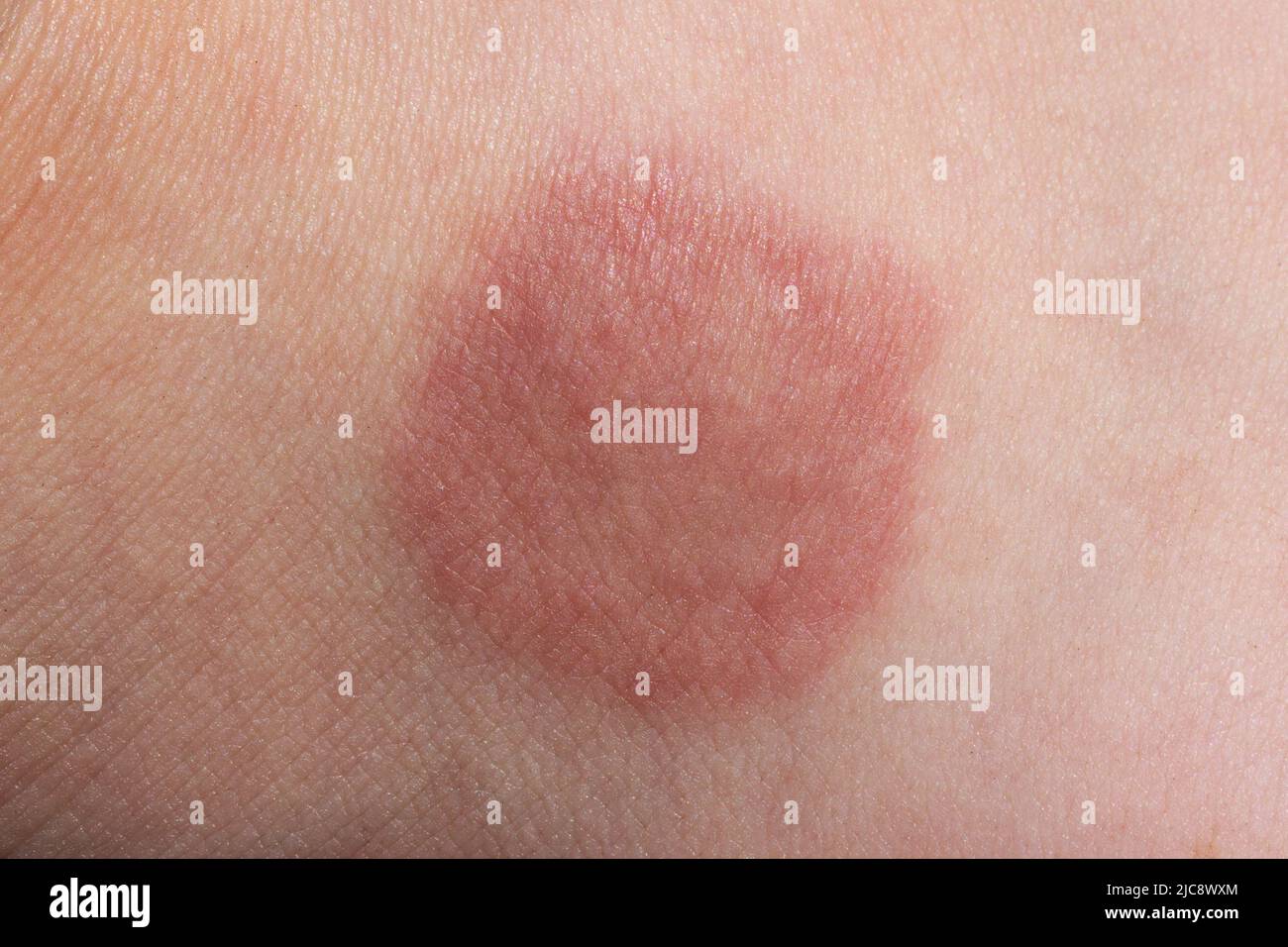 Cutaneous Erythrasma