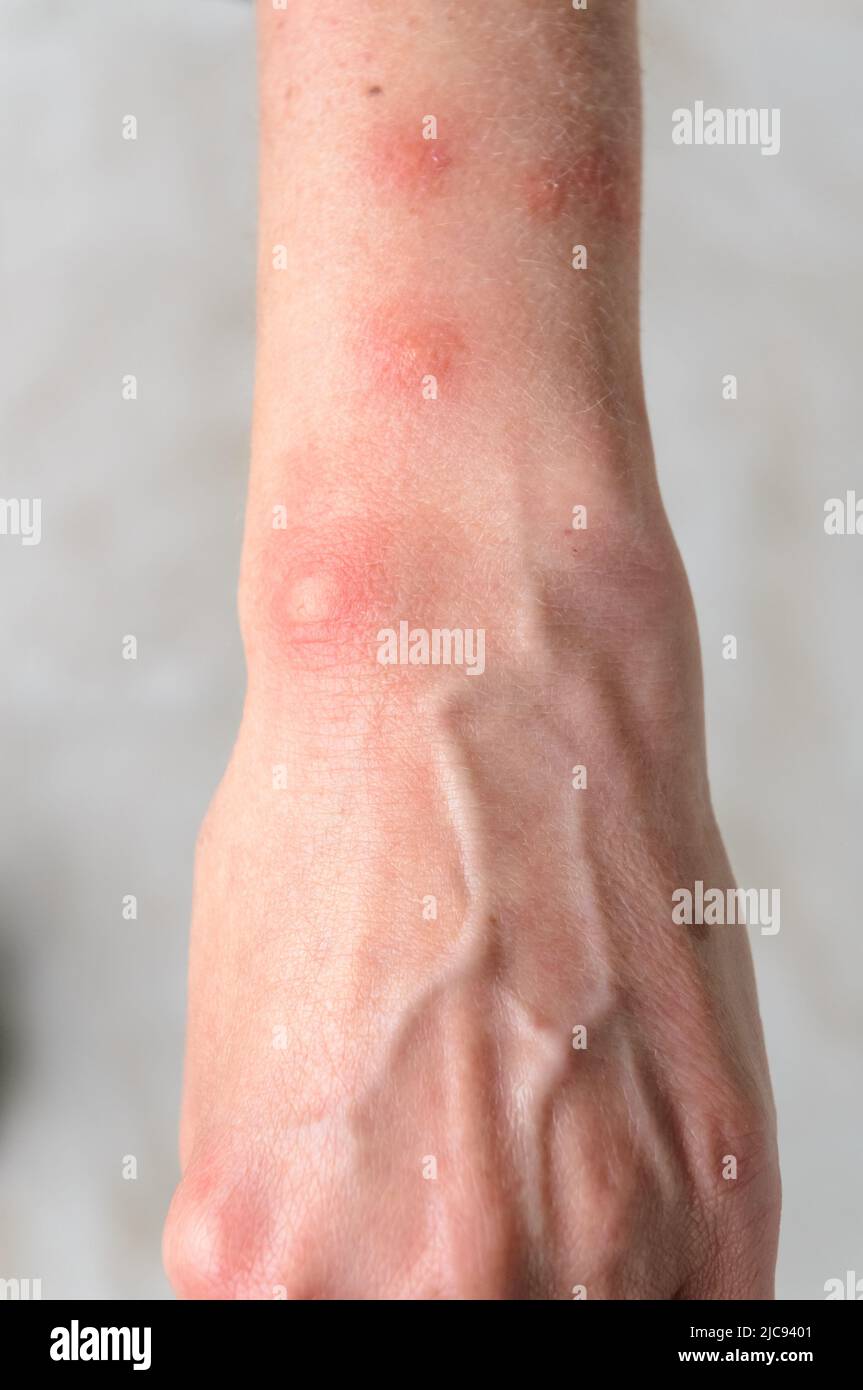 Itchy red swelling hi-res stock photography and images - Alamy