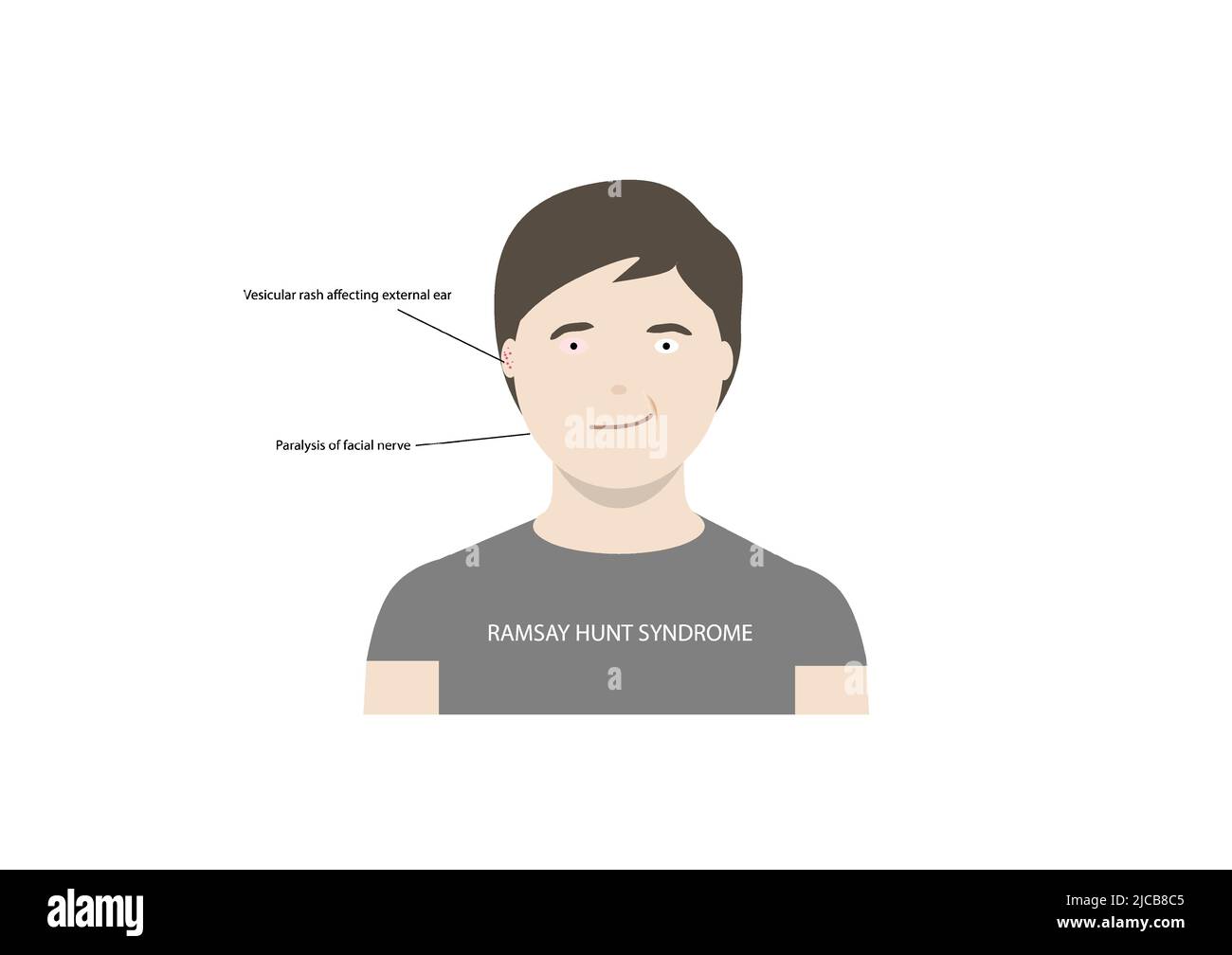 Vector illustration of man with ramsay hunt syndrome. A disorder ...