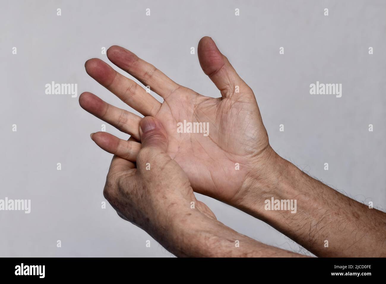 Cyanotic hands or peripheral cyanosis or blue hands at Southeast Asian ...