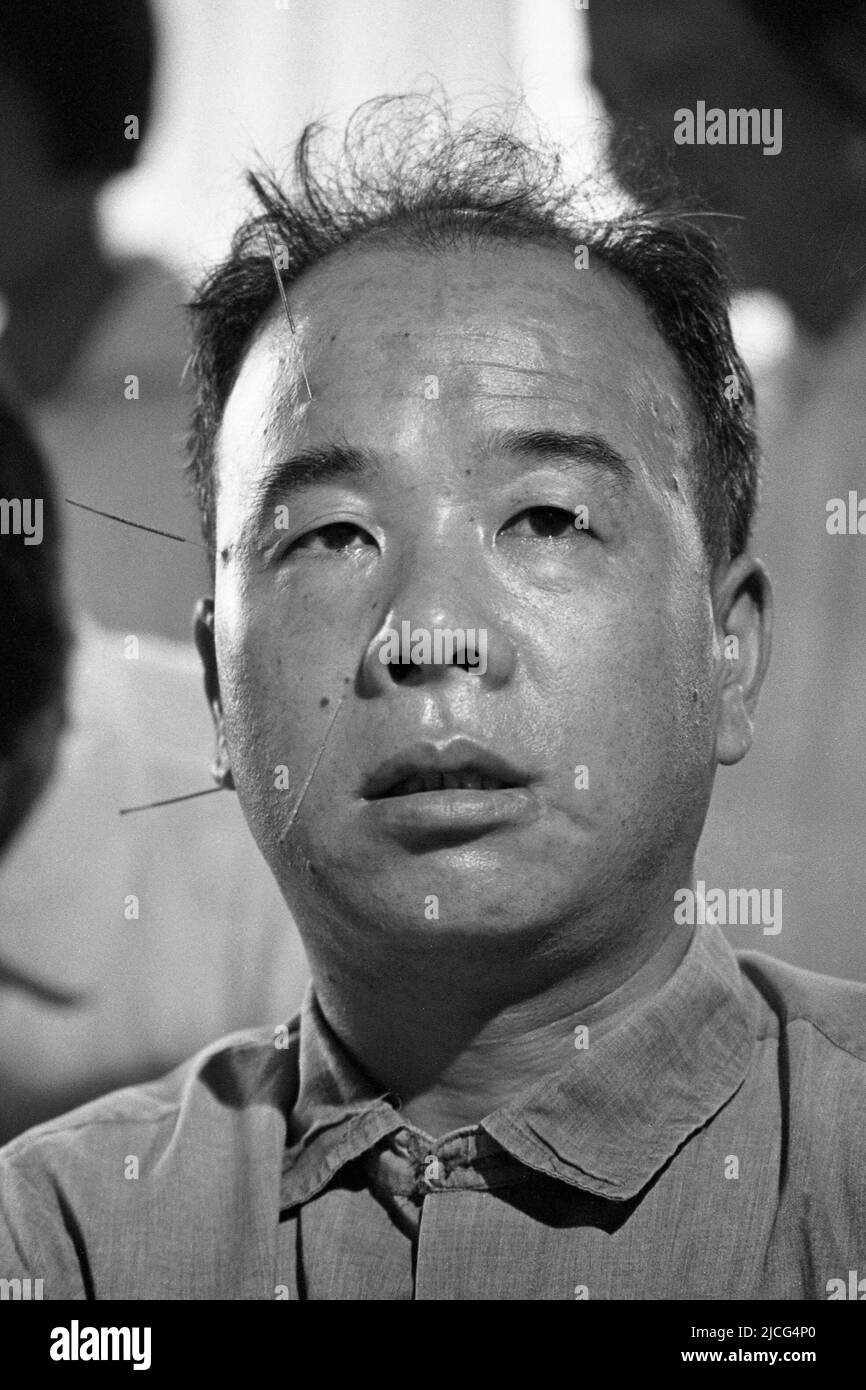 chinese man having multiple acupuncture needles on his face ...