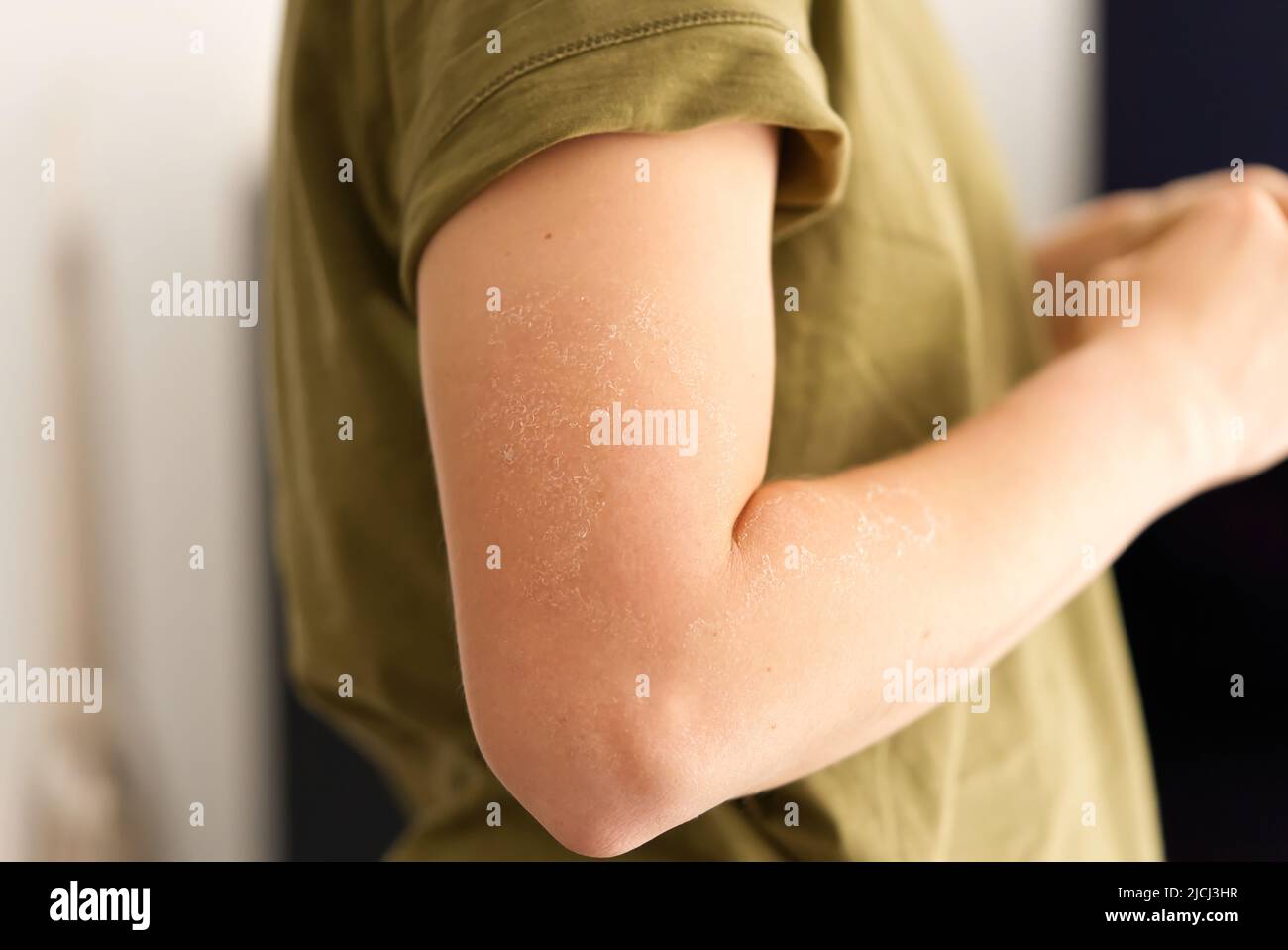 Girl with sunburnt shoulders hi-res stock photography and images - Alamy