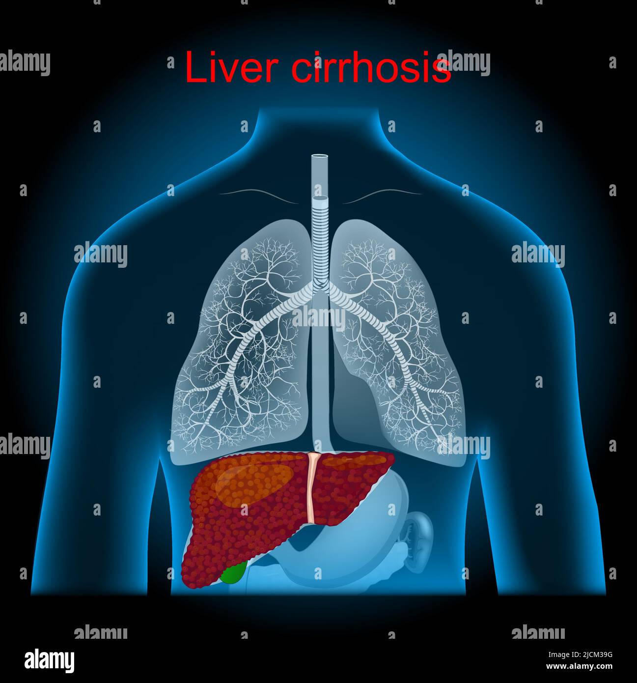 Cirrhosis. liver have damage that characterized by the replacement of ...