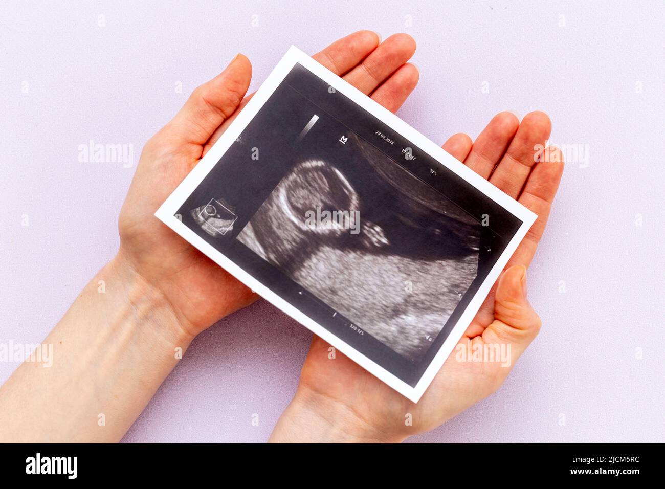 Sonography pregnancy picture of embryo in wonams hands Stock Photo - Alamy