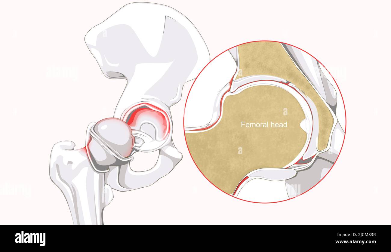 Hip joint labrum Cut Out Stock Images & Pictures - Alamy