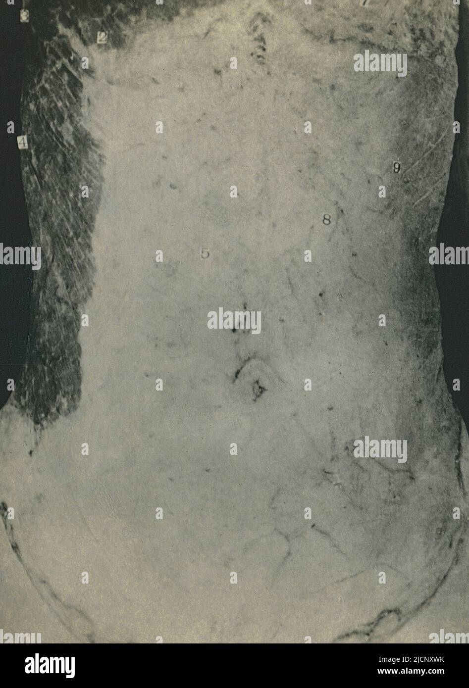 Dissection of a human body showing the external oblique muscles and ...