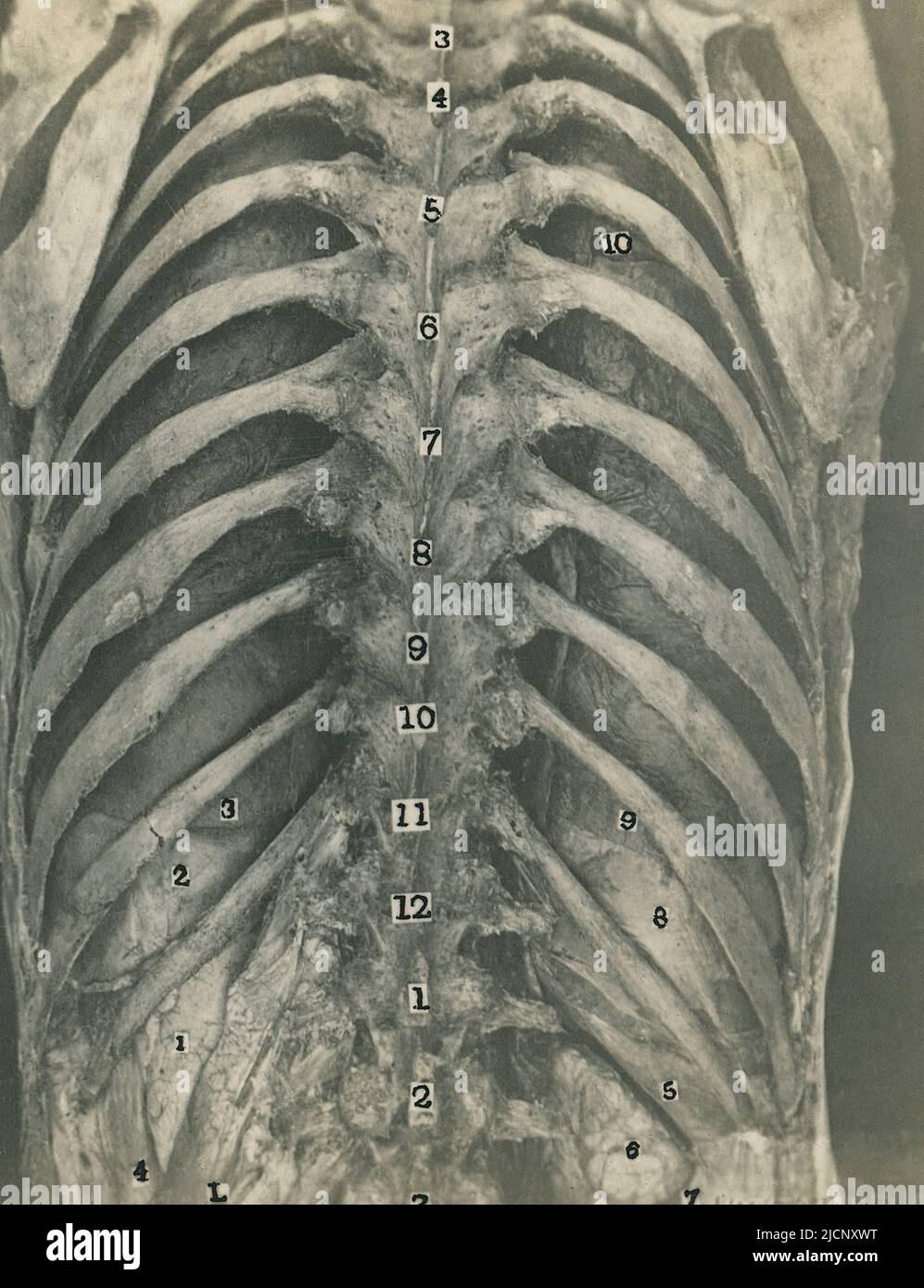Cadaver dissection showing the thorax Stock Photo - Alamy