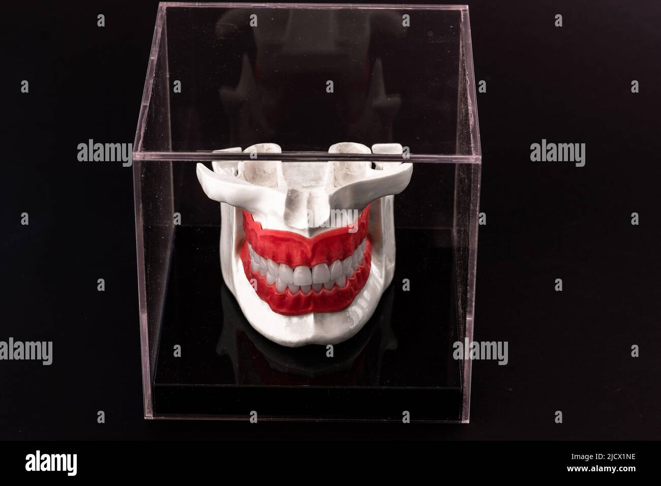 Human jaw with teeth implants anatomy model isolated on black ...