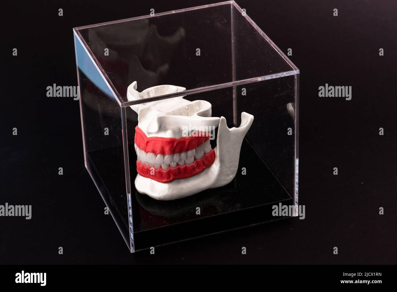 Human jaw with teeth implants anatomy model isolated on black ...
