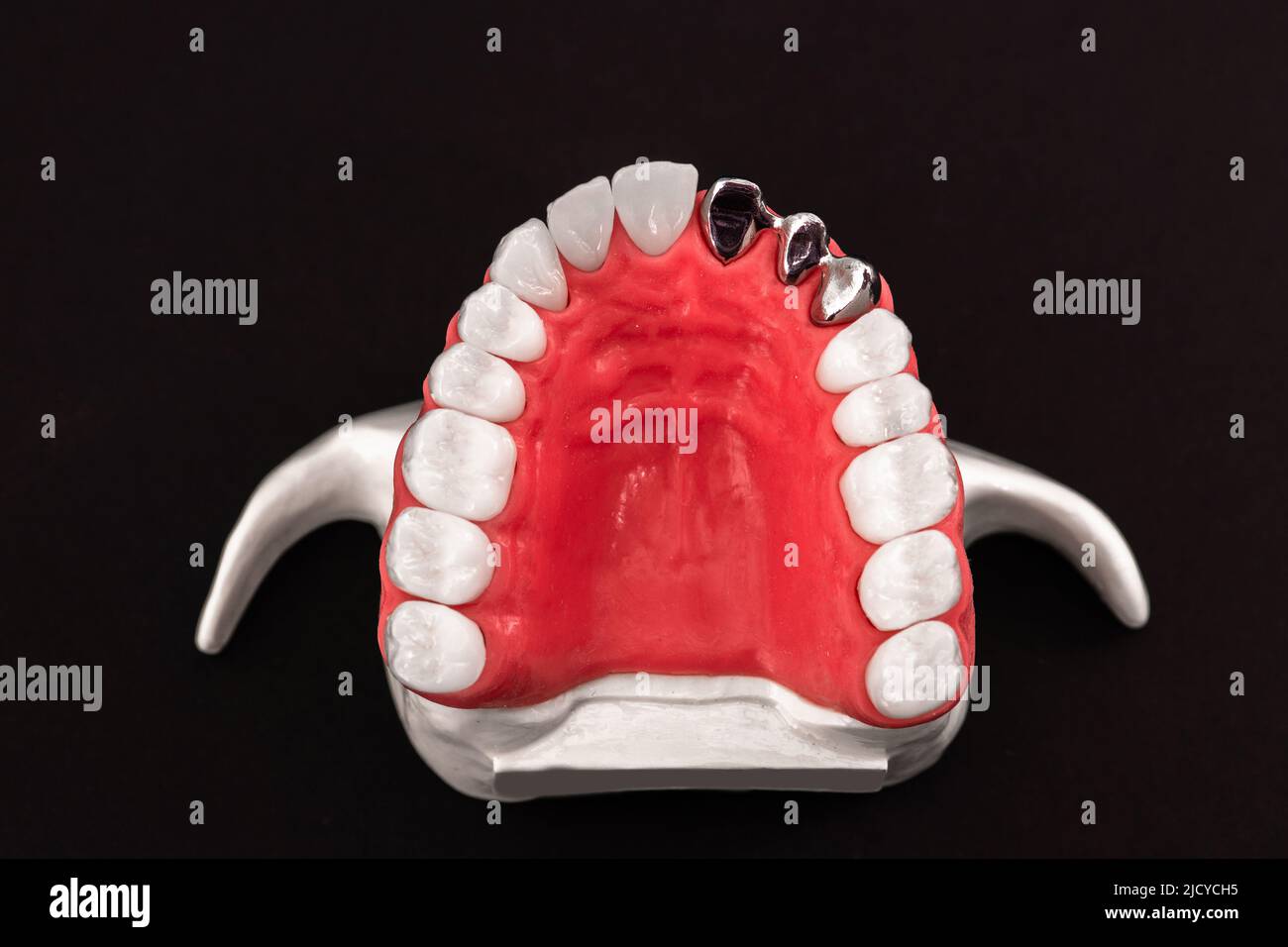 Teeth implant and crown installation process parts isolated on a blue ...