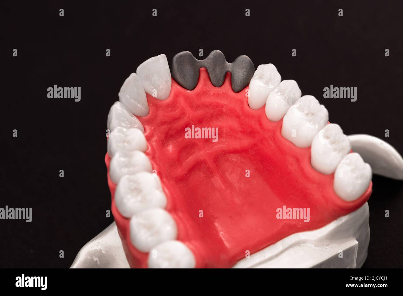Teeth implant and crown installation process parts isolated on a blue ...