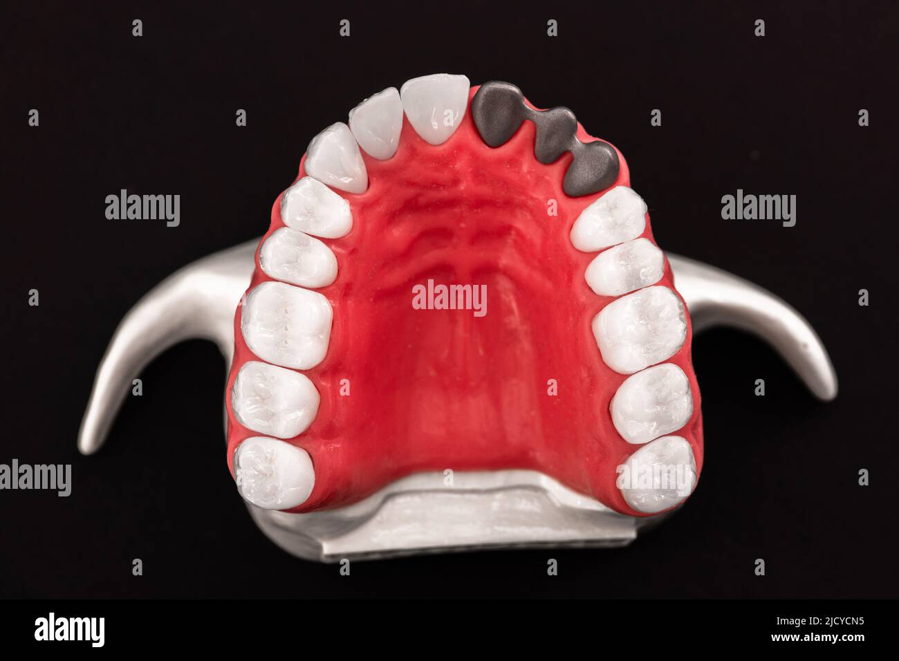 Teeth implant and crown installation process parts isolated on a blue ...
