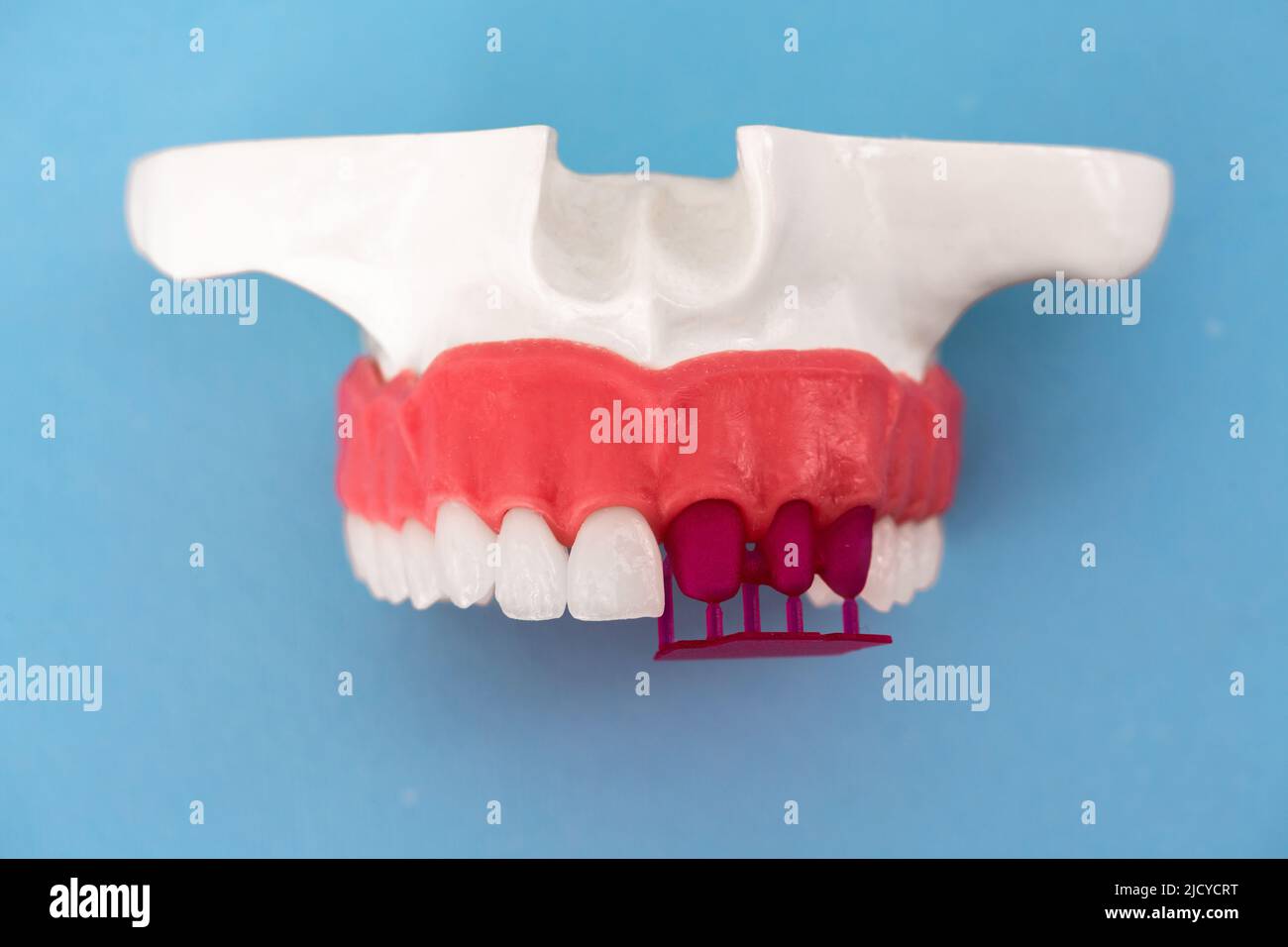 Teeth implant and crown installation process parts isolated on a blue ...