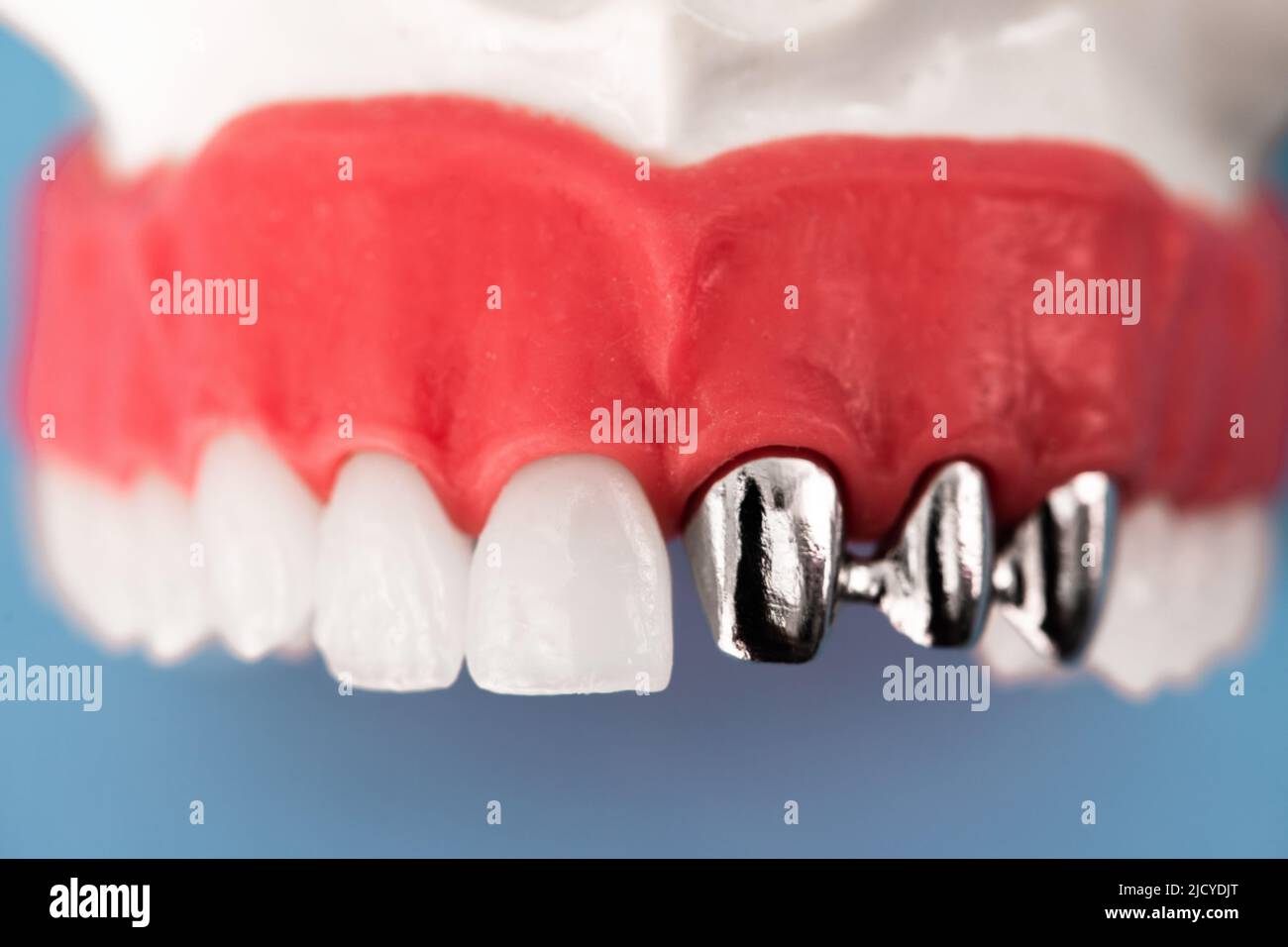 Teeth implant and crown installation process parts isolated on a blue ...